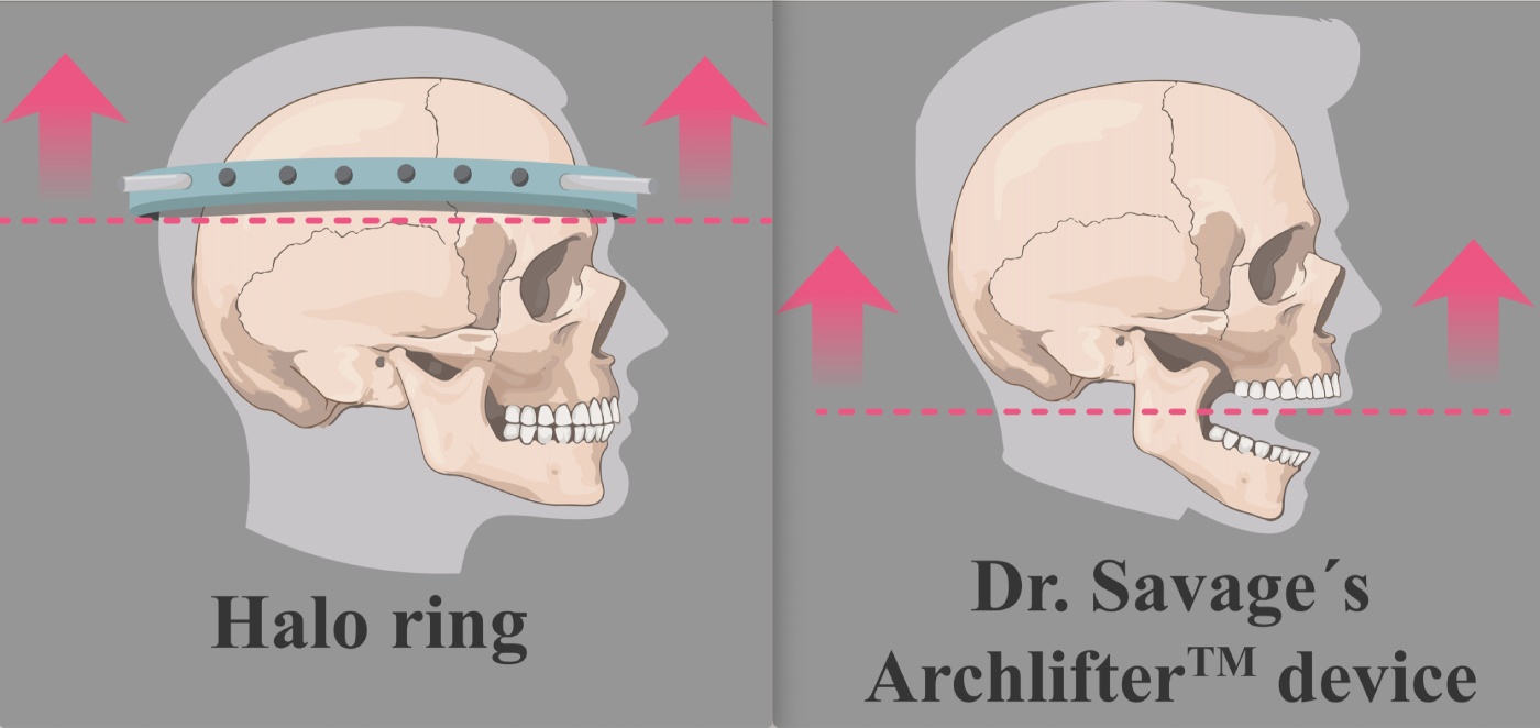 Archlifter™ - The Ultimate Neck & Spine Fitness Device
